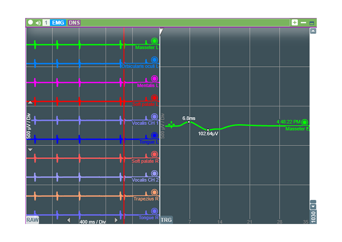 ISIS IOM family: Systems for neurophysiological monitoring