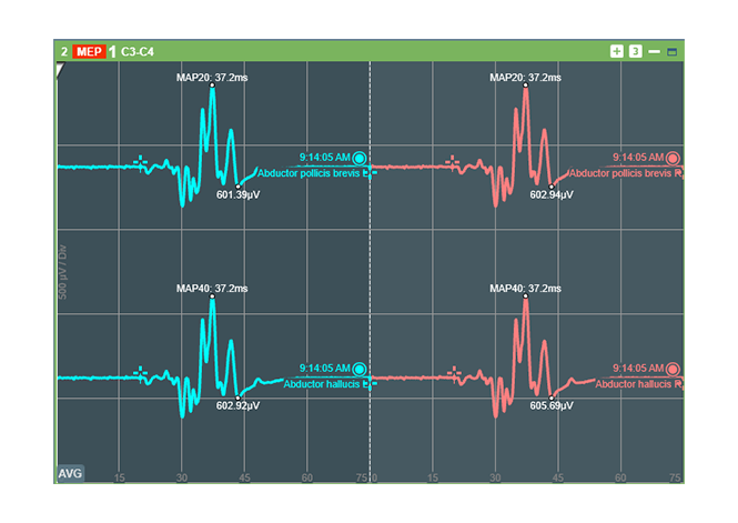 ISIS IOM family: Systems for neurophysiological monitoring