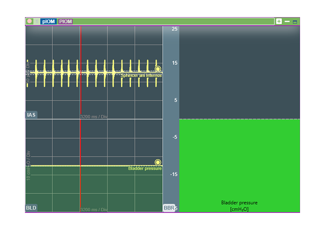 ISIS IOM family: Systems for neurophysiological monitoring