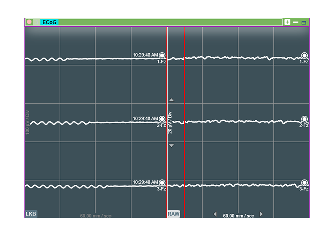 ISIS IOM family: Systems for neurophysiological monitoring