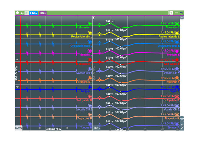 ISIS IOM family: Systems for neurophysiological monitoring