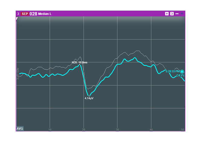 ISIS IOM family: Systems for neurophysiological monitoring