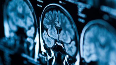 ISIS IOM family: Systems for neurophysiological monitoring